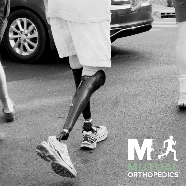 Custom Prosthetics in Nassau County - Mutual Orthopedics